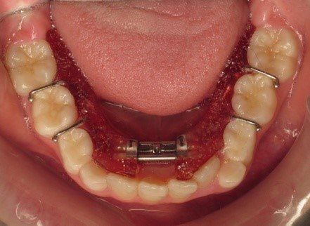 orthdontic treatment for kids - Eberle Orthodontics