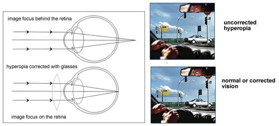 Eye Conditions - Dr. Brian Blake Optometrist